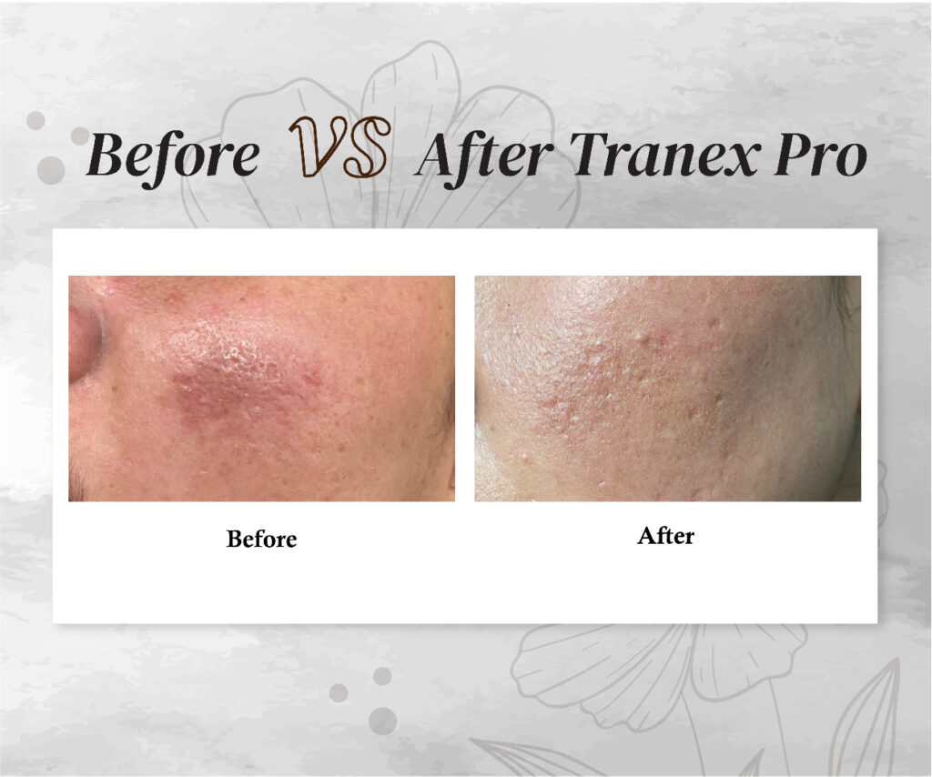 BSK14 TRANEX PRO – Bina Estetika Indonesia